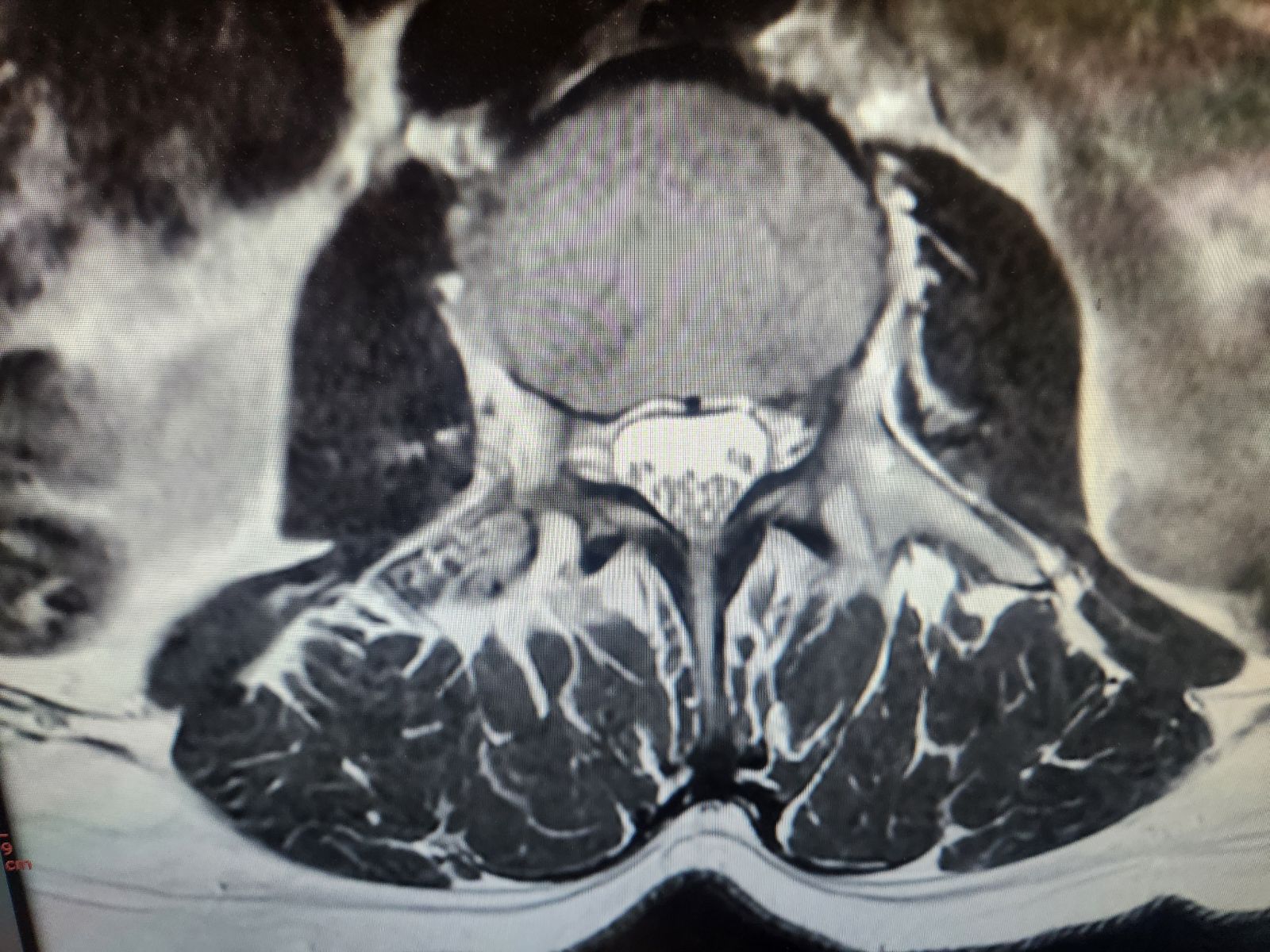 Small Endoscopic (See testimonials) – Nano Back Institute